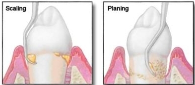 Scaling and Root Planing vs Standard Cleaning | Scaling and Root ...